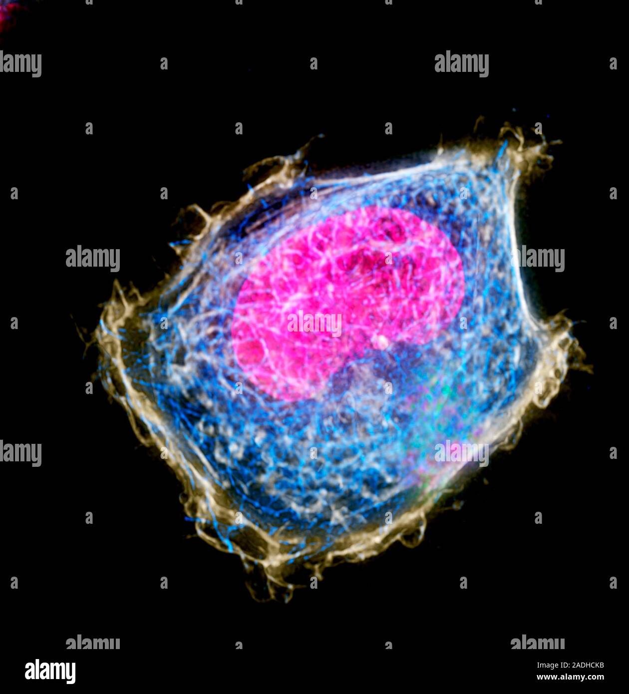 Cancer cell division. Immunofluorescent light micrograph of a cancer ...