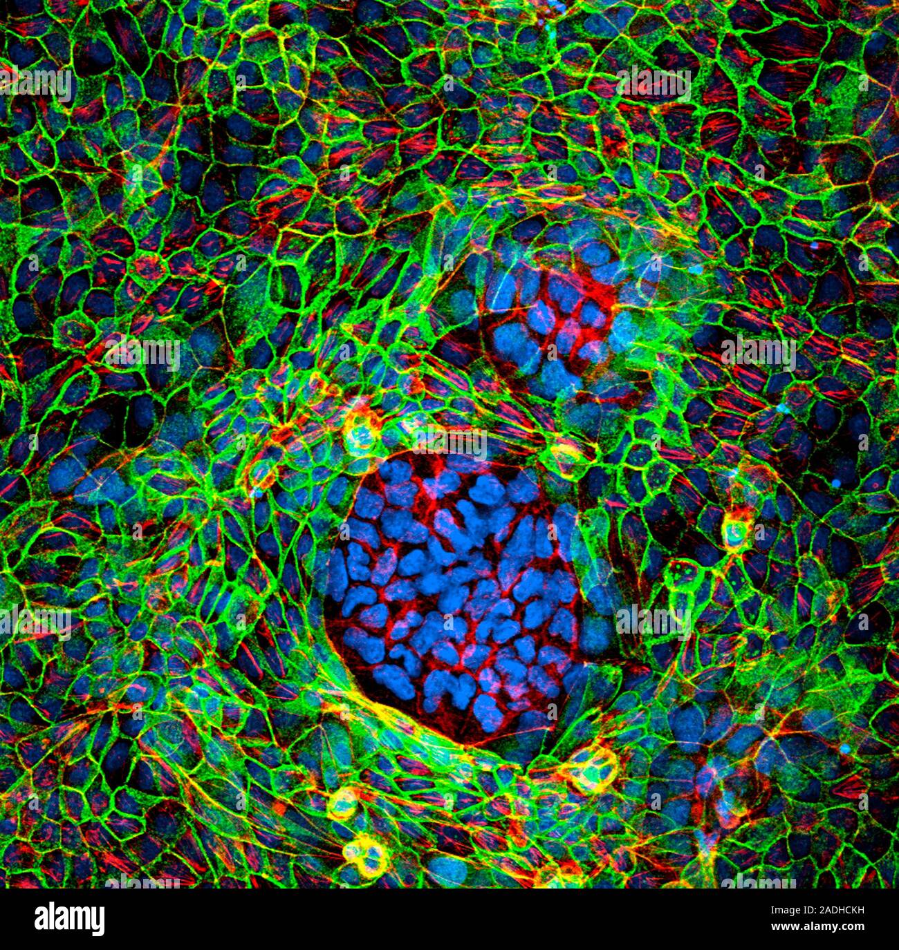 Cancer cells. Immunofluorescent light micrograph of a population of ...
