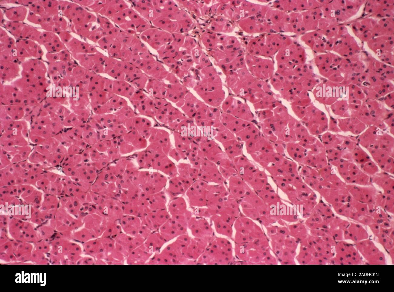 Salivary gland cancer. Light micrograph of a section through a parotid ...