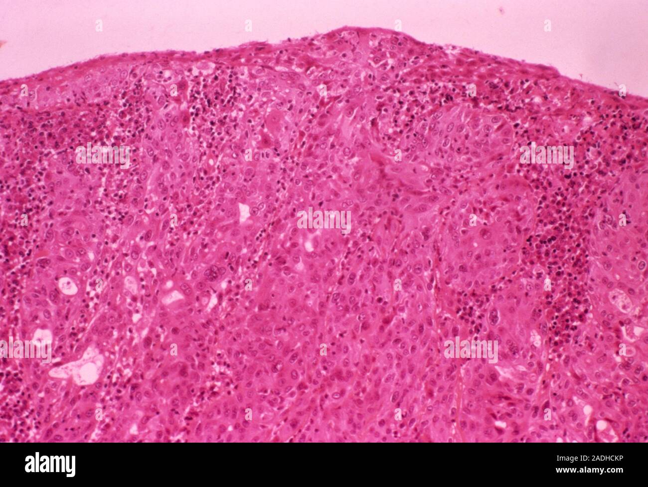 Vocal Cord Cancer Light Micrograph Of A Section Through Vocal Cord