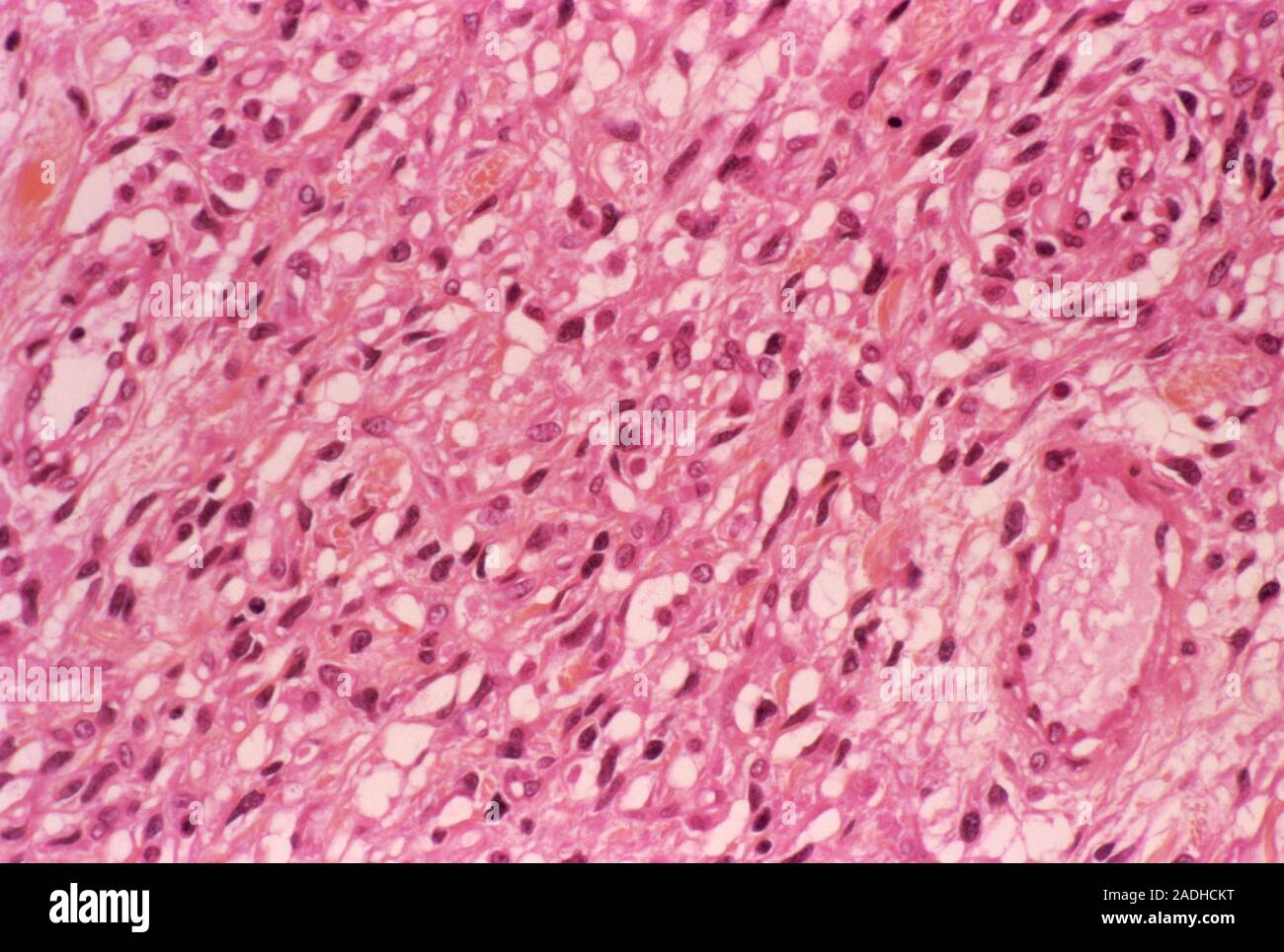 Liposarcoma. Light micrograph of cancerous fat tissue. This is a ...