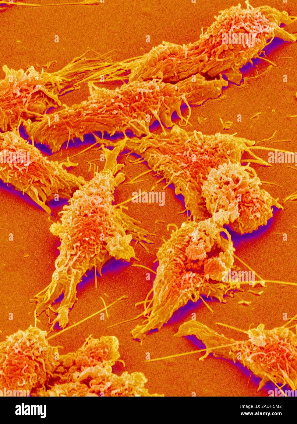 Colon cancer. Coloured scanning electron micrograph (SEM) of cancer ...
