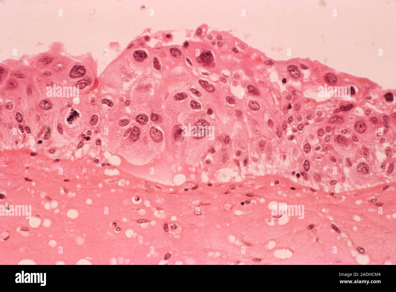 Bladder cancer. Light micrograph of tissue from the wall of the urinary ...