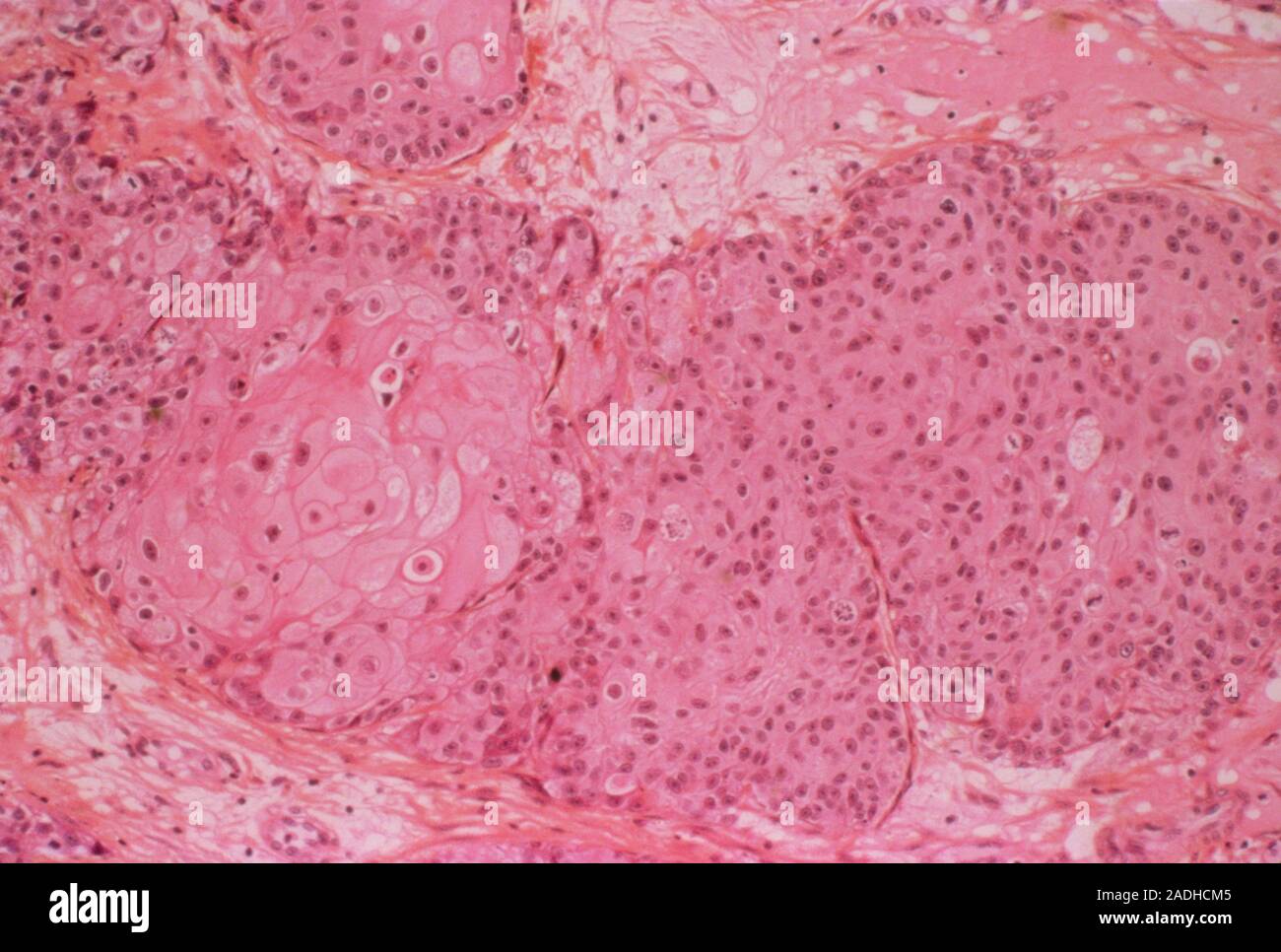 Bladder cancer. Light micrograph showing cancerous cells (across centre ...