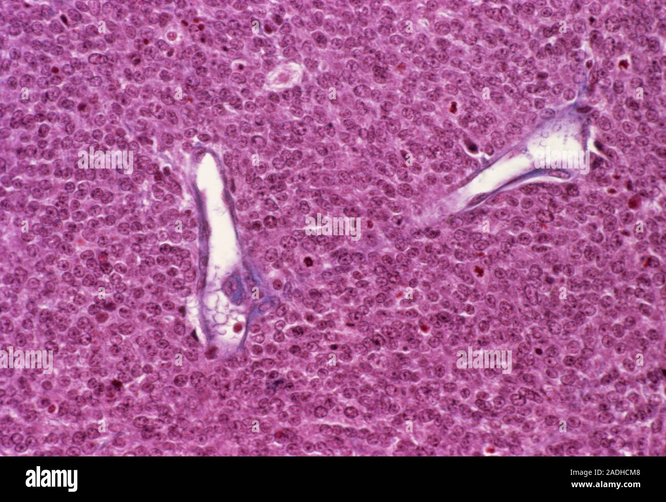 Lymphoma brain tumour. Light micrograph of a section through brain ...