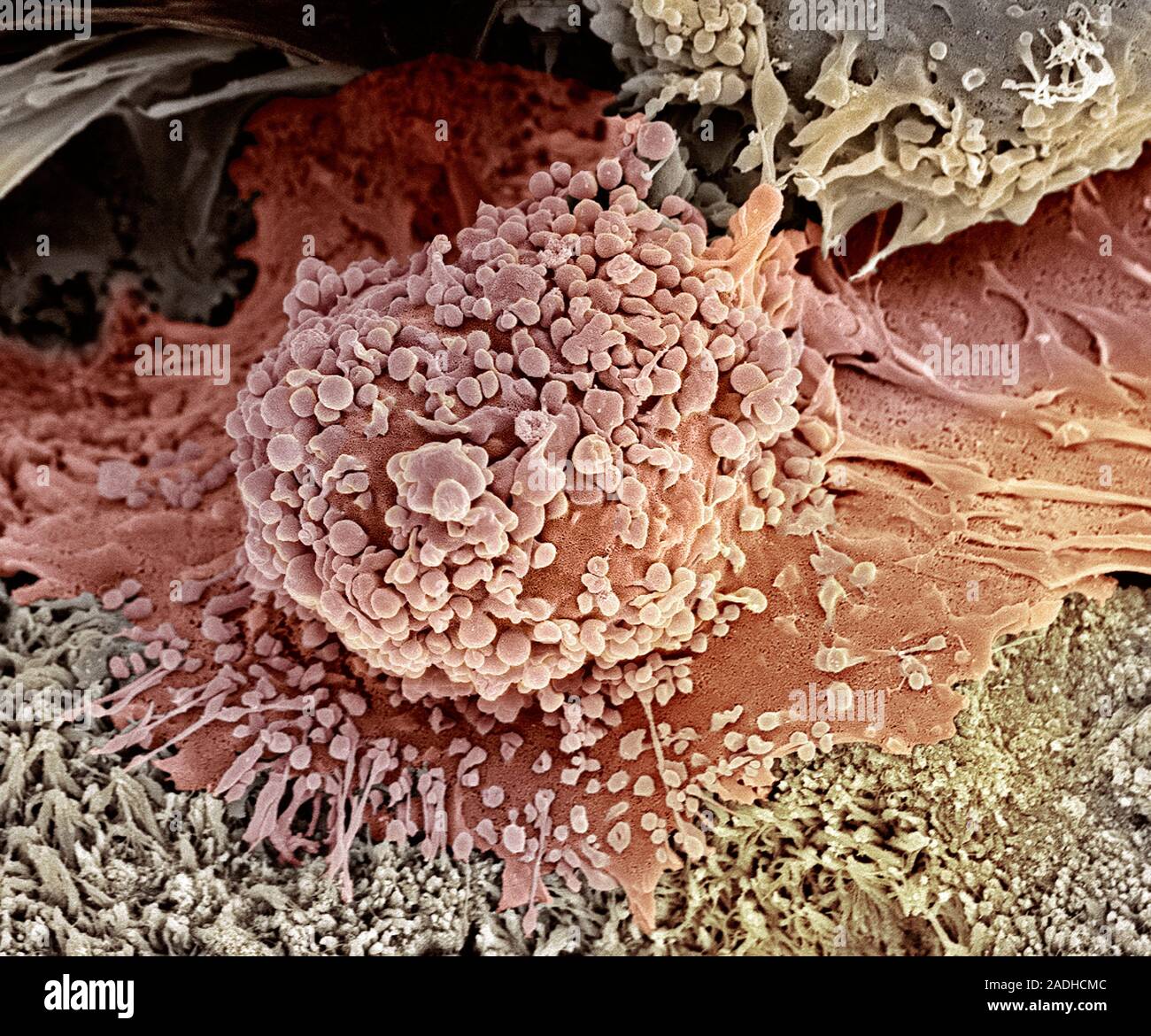 Bone cancer cell. Coloured scanning electron micrograph (SEM) of a bone ...