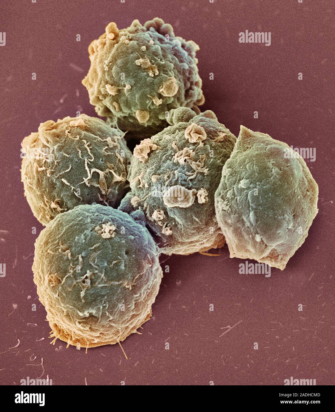 Lymphoma cells. Coloured scanning electron micrograph (SEM) of lymphoma ...