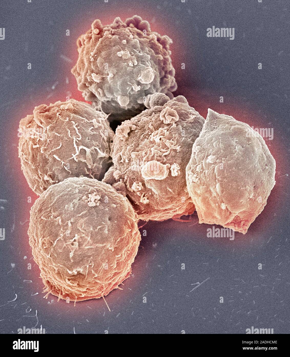 Lymphoma cells. Coloured scanning electron micrograph (SEM) of lymphoma ...