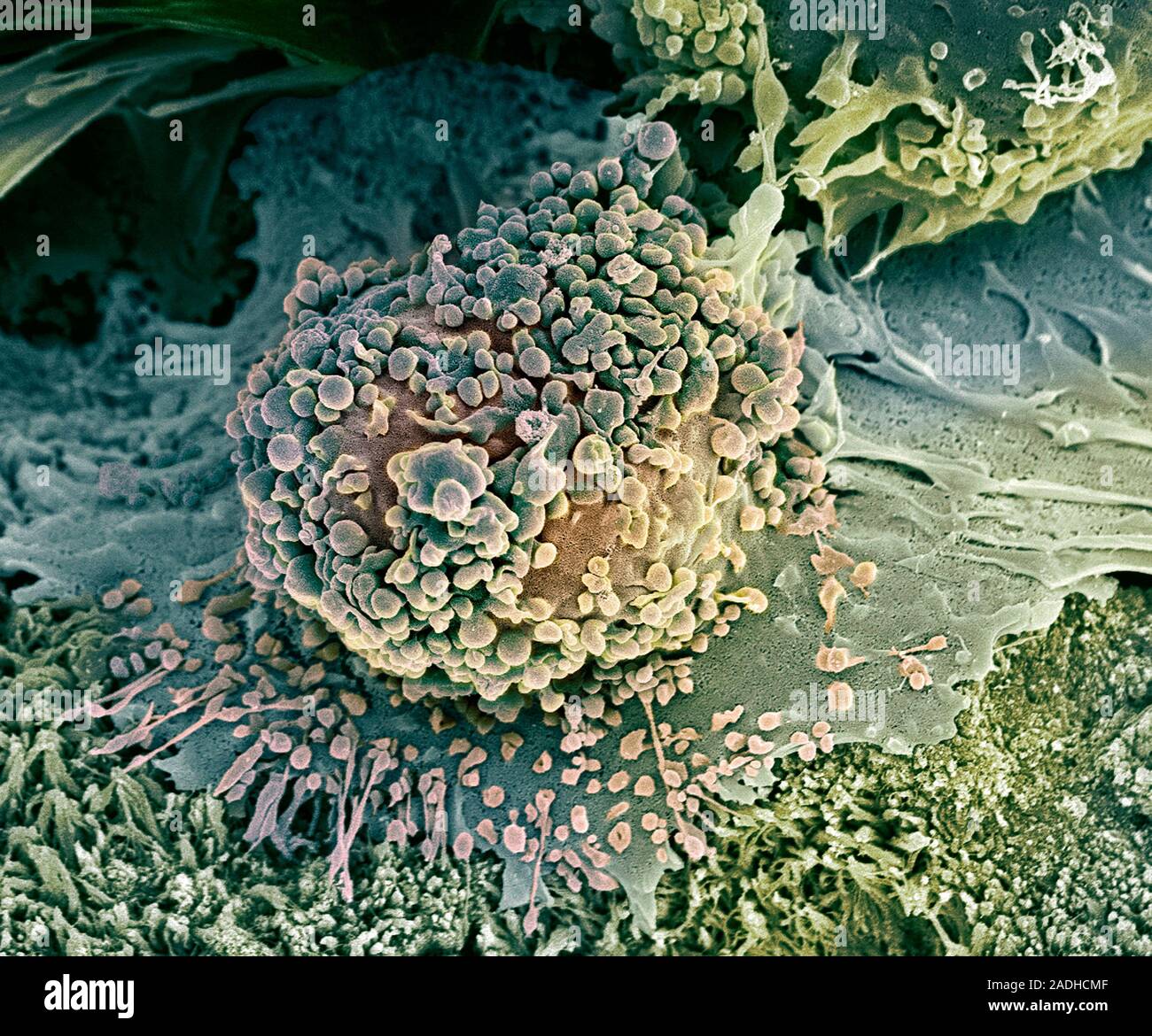 Bone cancer cell. Coloured scanning electron micrograph (SEM) of a bone ...