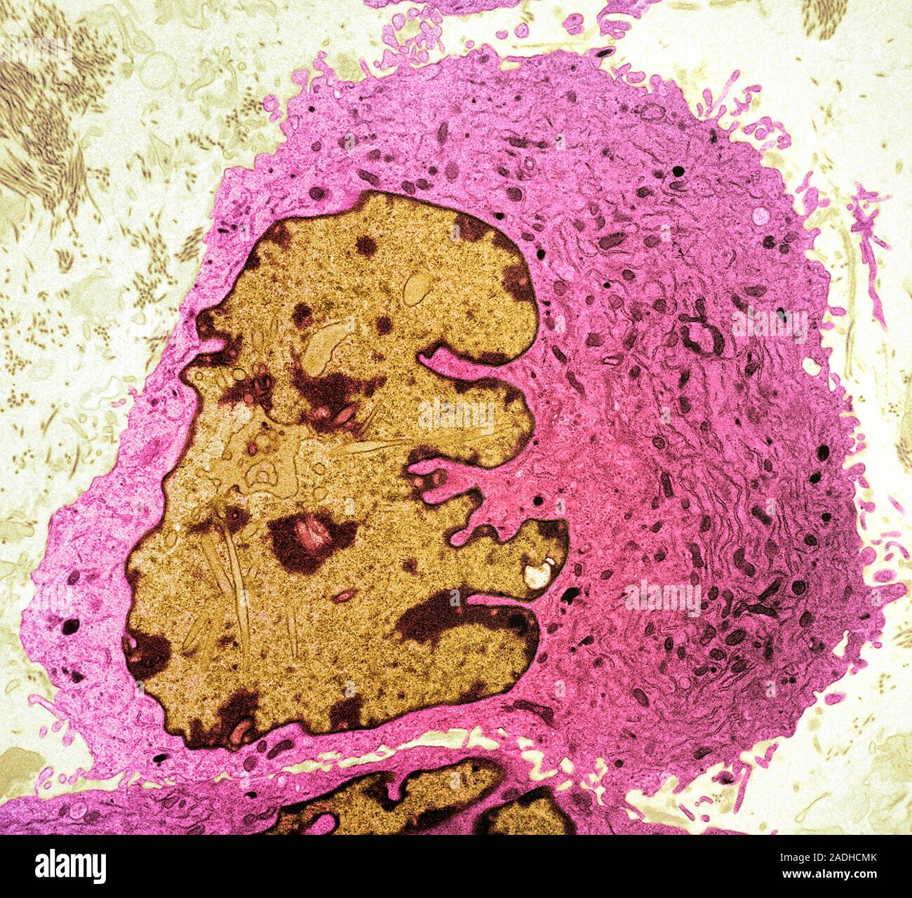 Sarcoma cell. Coloured transmission electron micrograph of a sarcoma ...