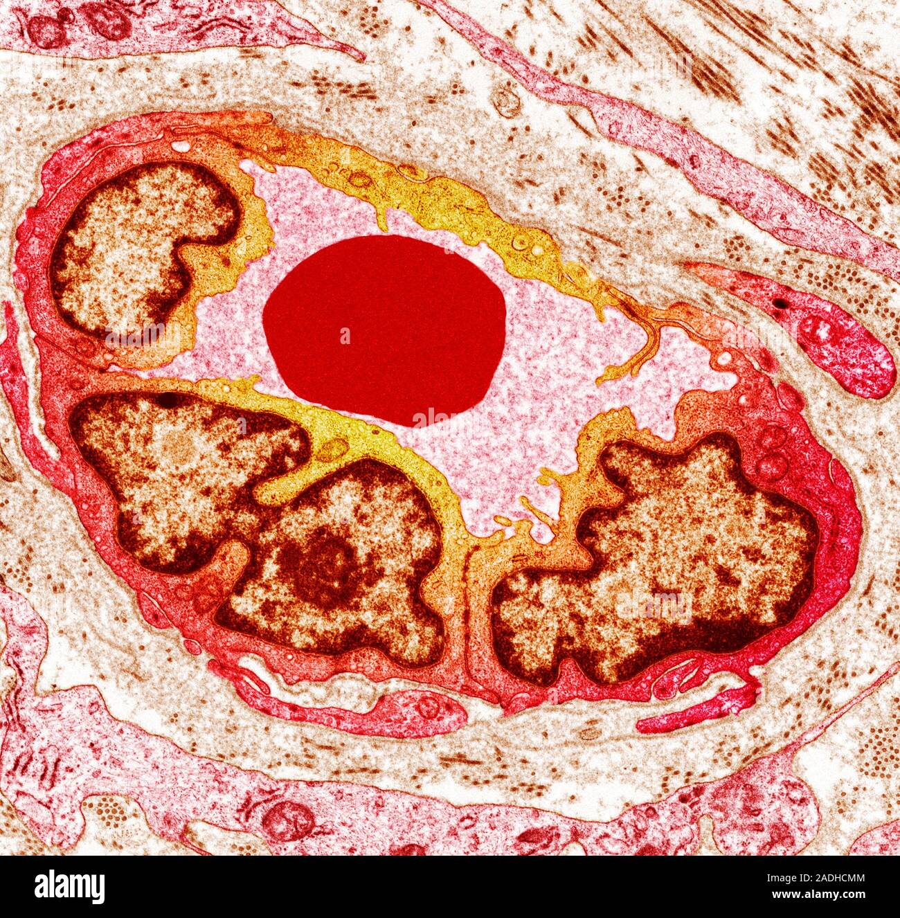 Tumour. Coloured transmission electron micrograph (TEM) of a capillary ...