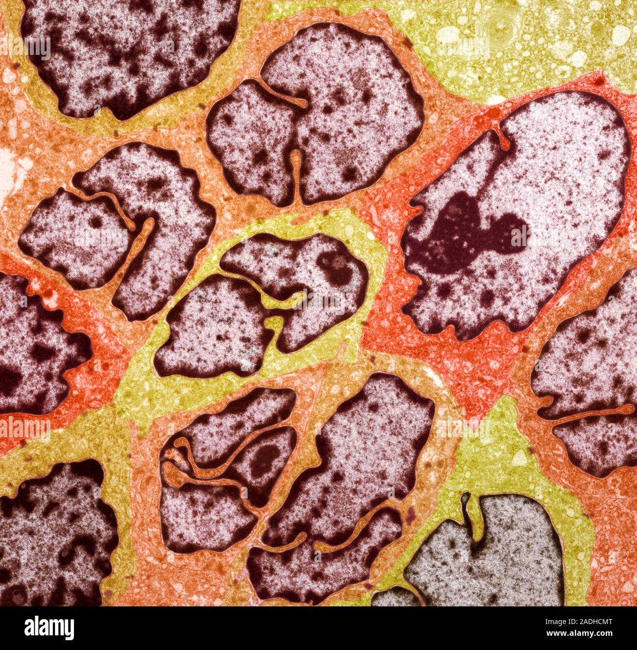 Liver cancer cells. Coloured transmission electron micrograph (TEM) of ...