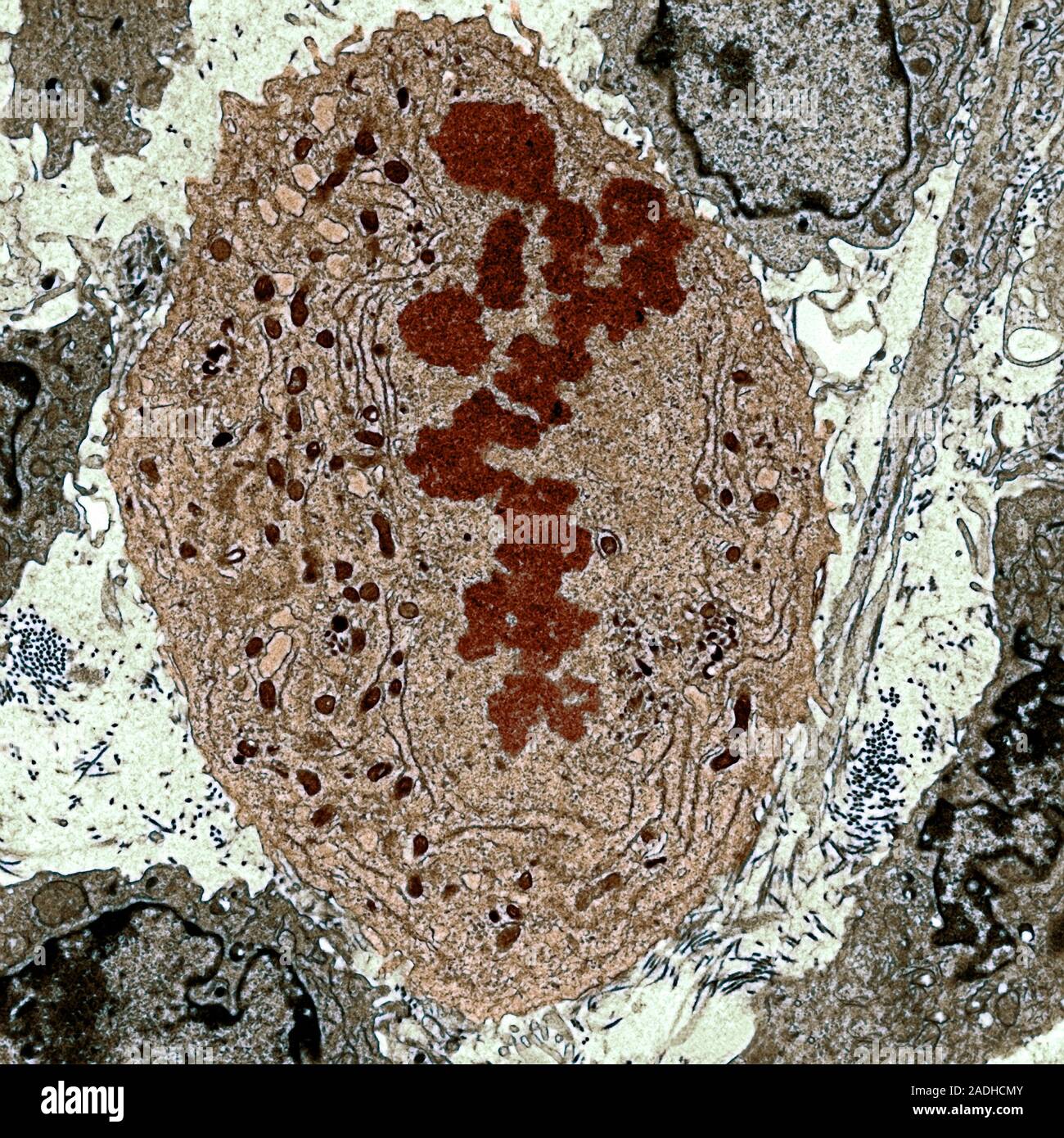 Dividing sarcoma cell. Coloured transmission electron micrograph of a ... Dividing sarcoma cell. Coloured transmission electron micrograph of a ...