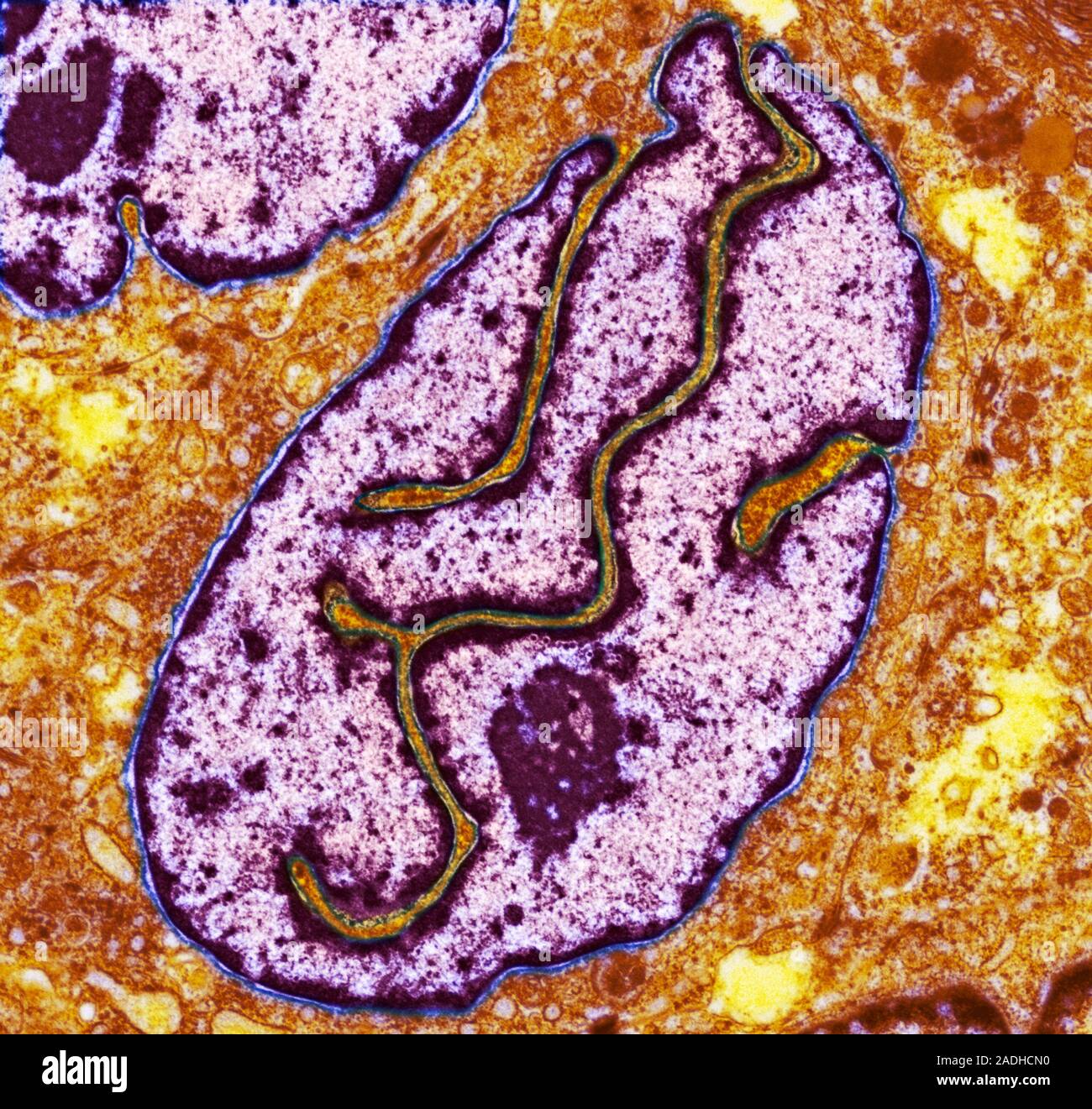 Liver cancer cell nucleus. Coloured transmission electron micrograph ...