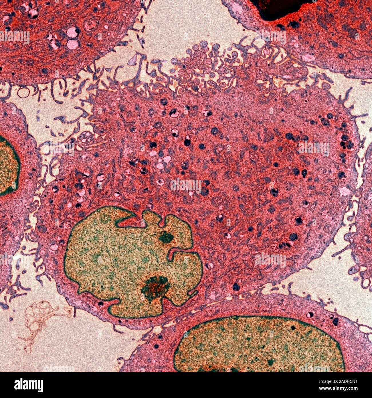 Leukaemia cells in a patient with Bloom's syndrome, coloured ...