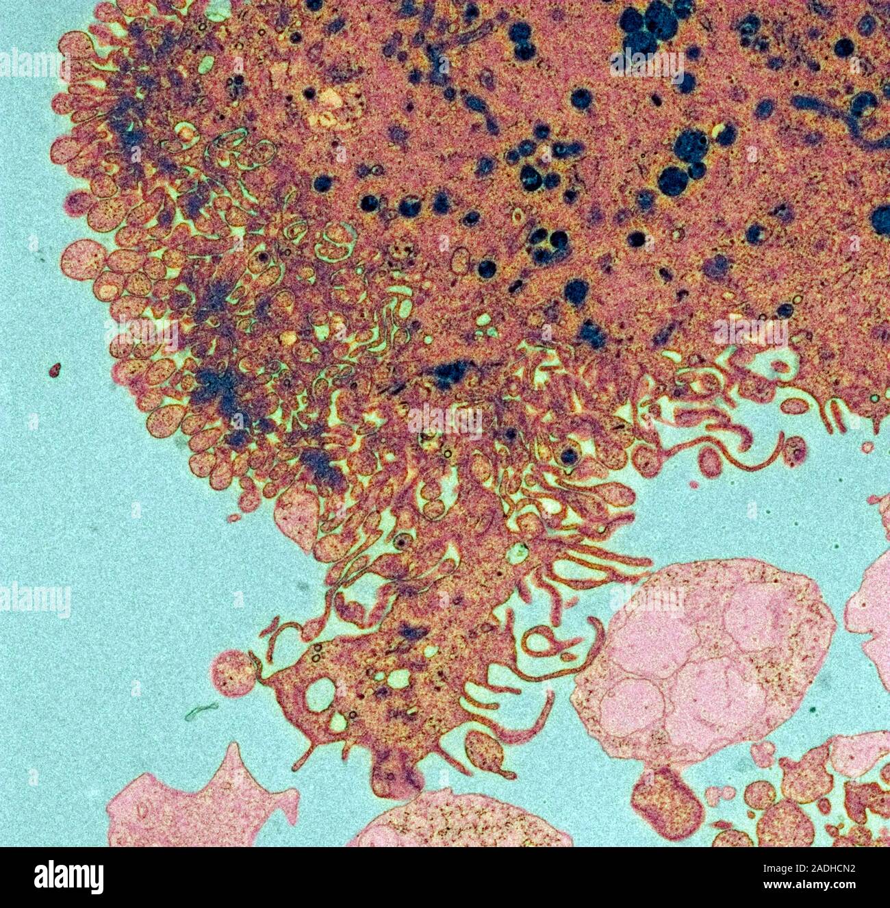 Leukaemia cell in a patient with Bloom's syndrome, coloured ...