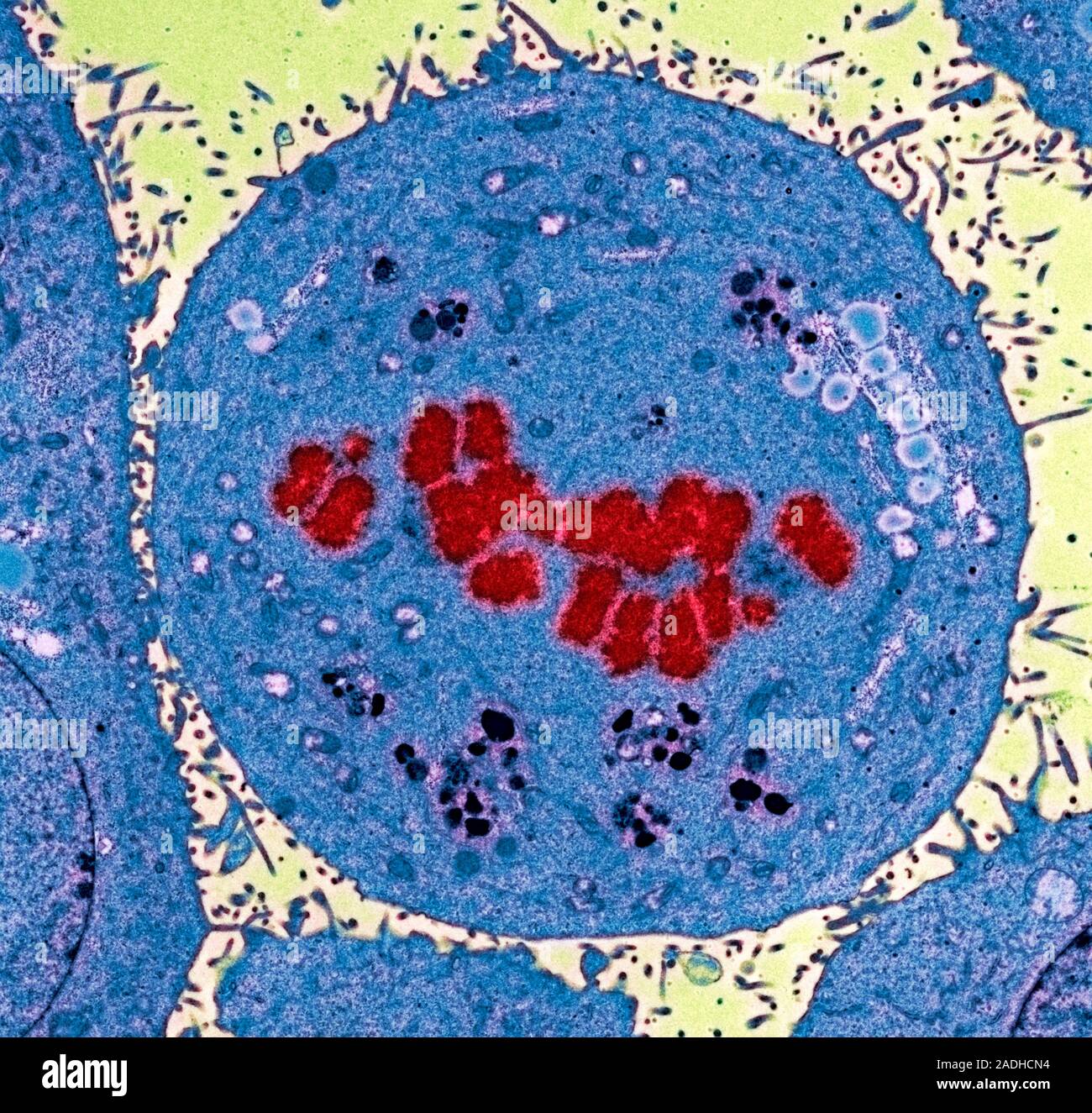 Dividing carcinoma cell, coloured transmission electron micrograph (TEM ... Dividing carcinoma cell, coloured transmission electron micrograph (TEM ...