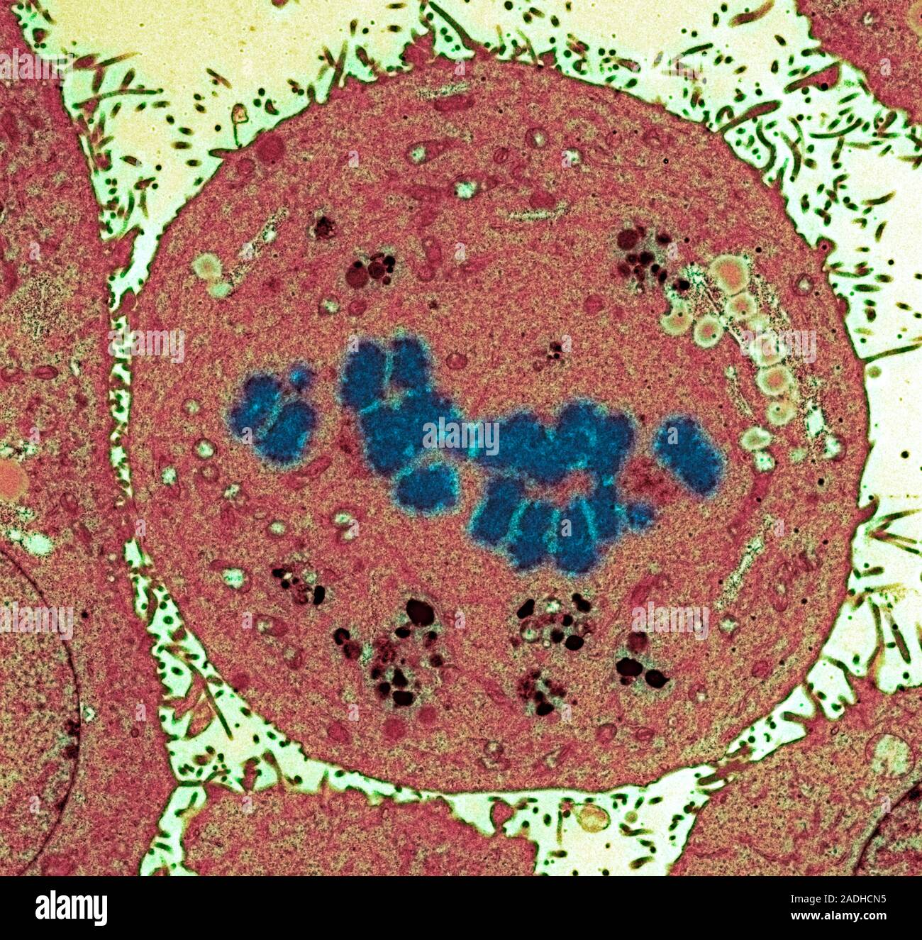 Dividing carcinoma cell, coloured transmission electron micrograph (TEM ...
