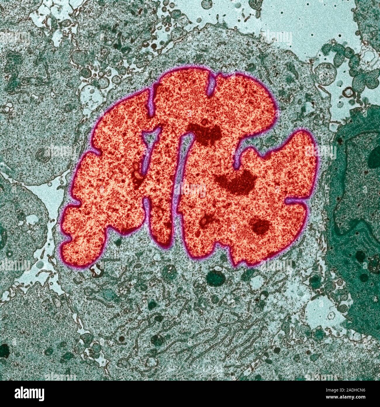 Lung cancer cell, coloured transmission electron micrograph (TEM). This ...