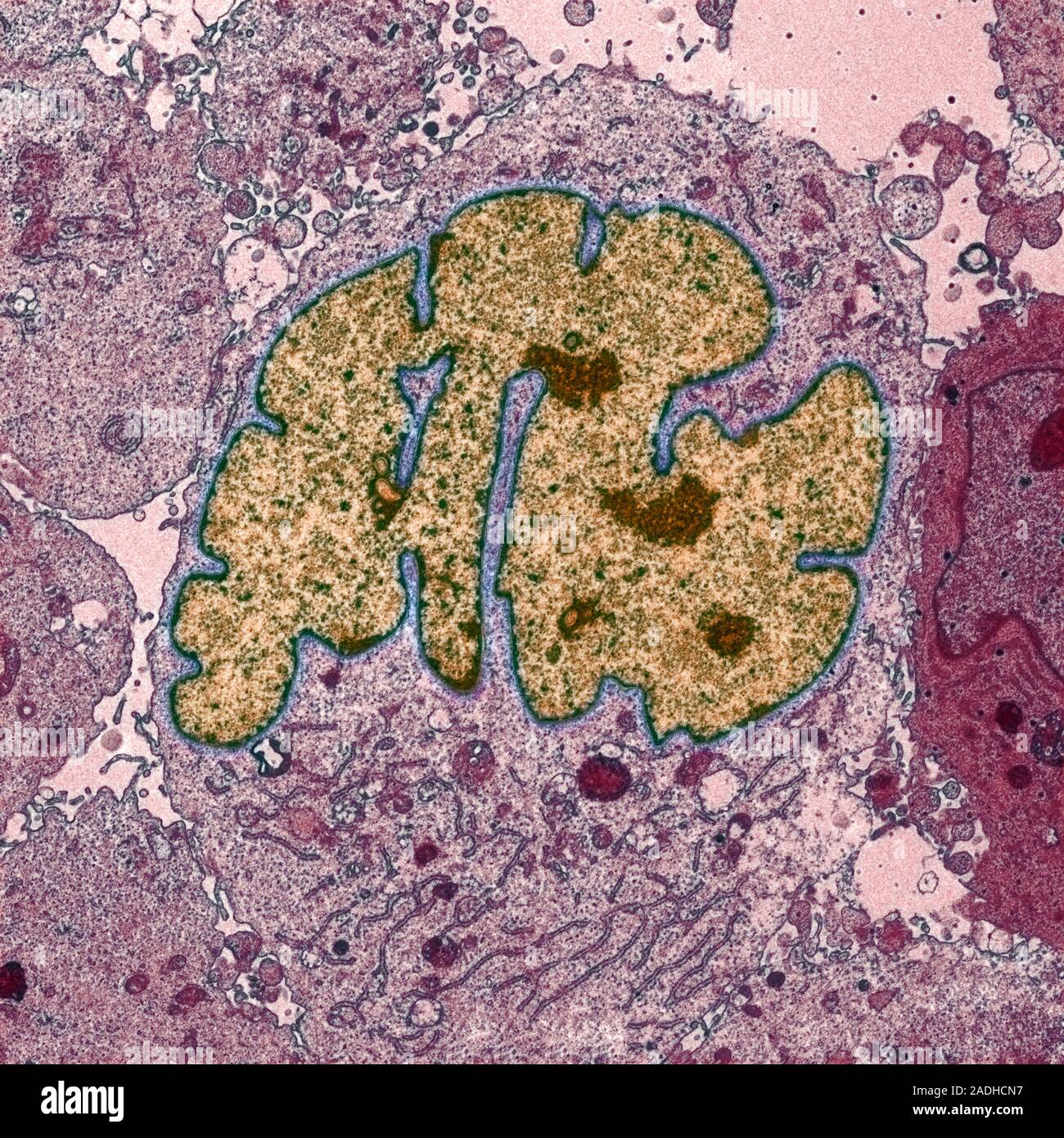 Lung cancer cell, coloured transmission electron micrograph (TEM). This ...