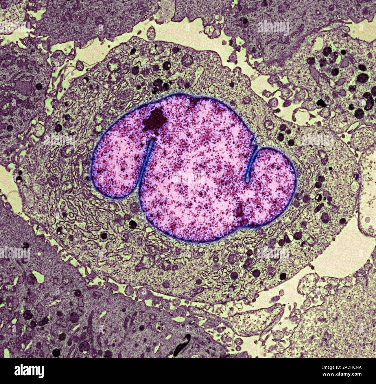 Lung cancer cell, coloured transmission electron micrograph (TEM). This ...