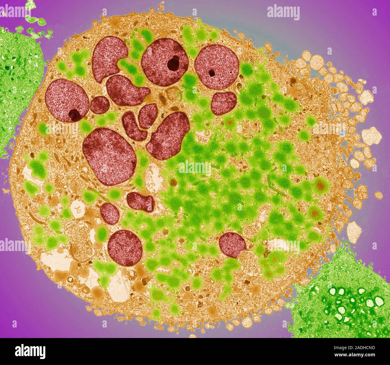 Bladder cancer cell. Coloured transmission electron micrograph (TEM) of ...