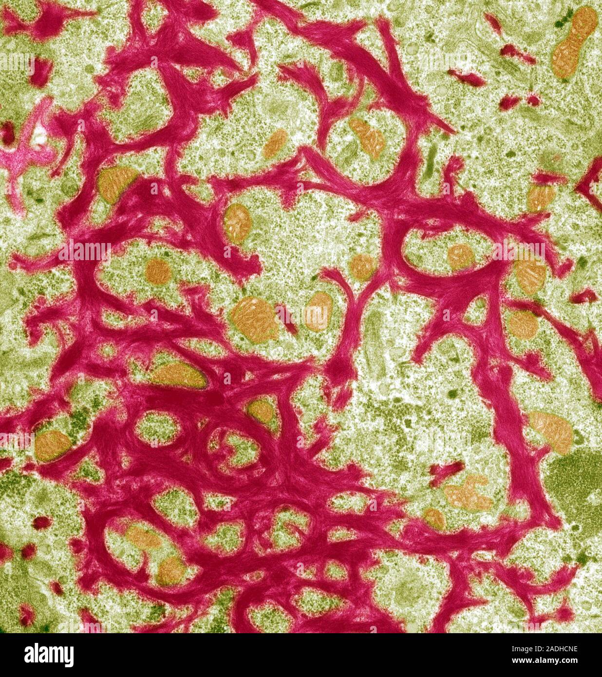 Skin cancer. Coloured transmission electron micrograph (TEM) of a ...