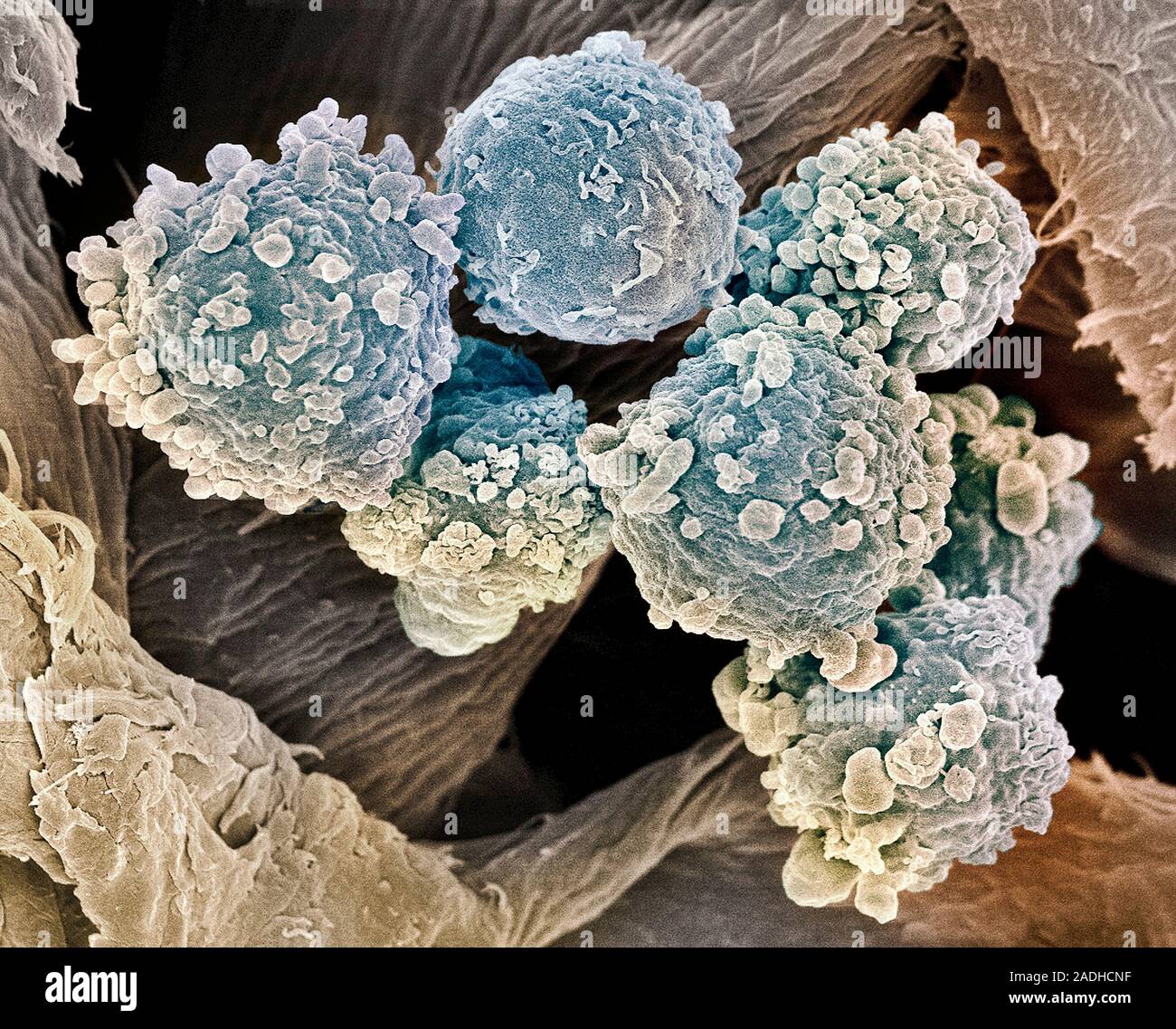 Leukaemia blood cells. Coloured scanning electron micrograph (SEM) of ...