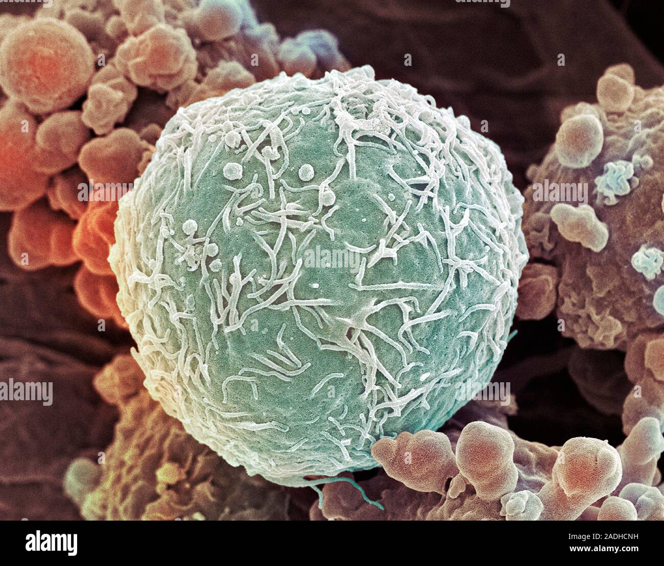 Leukaemia blood cell. Coloured scanning electron micrograph (SEM) of a ...