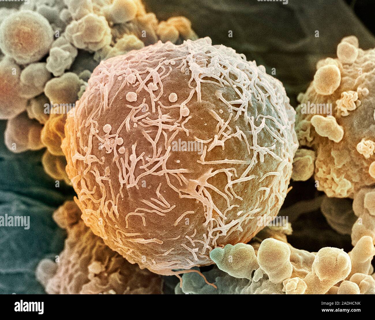 Leukaemia blood cell. Coloured scanning electron micrograph (SEM) of a ...
