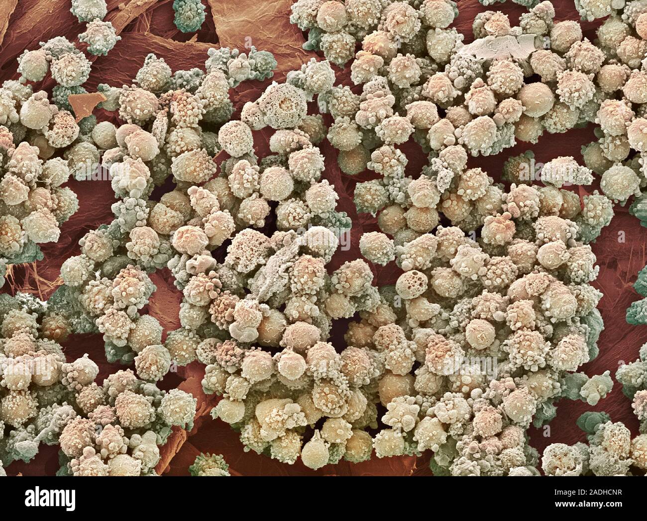 Leukaemia blood cells. Coloured scanning electron micrograph (SEM) of ...