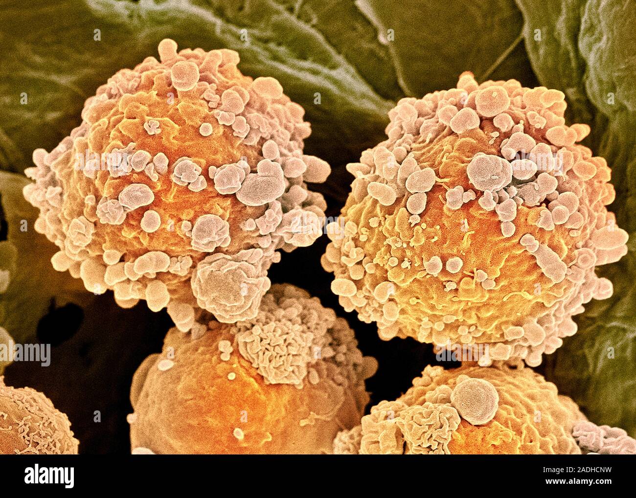 Leukaemia blood cells. Coloured scanning electron micrograph (SEM) of ...