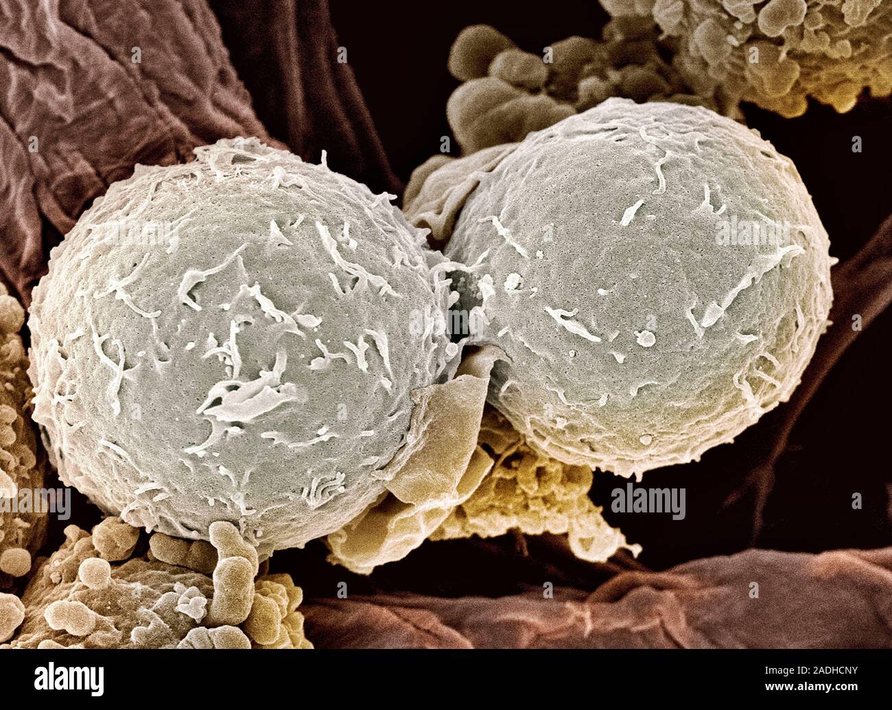 Leukaemia blood cells. Coloured scanning electron micrograph (SEM) of ...