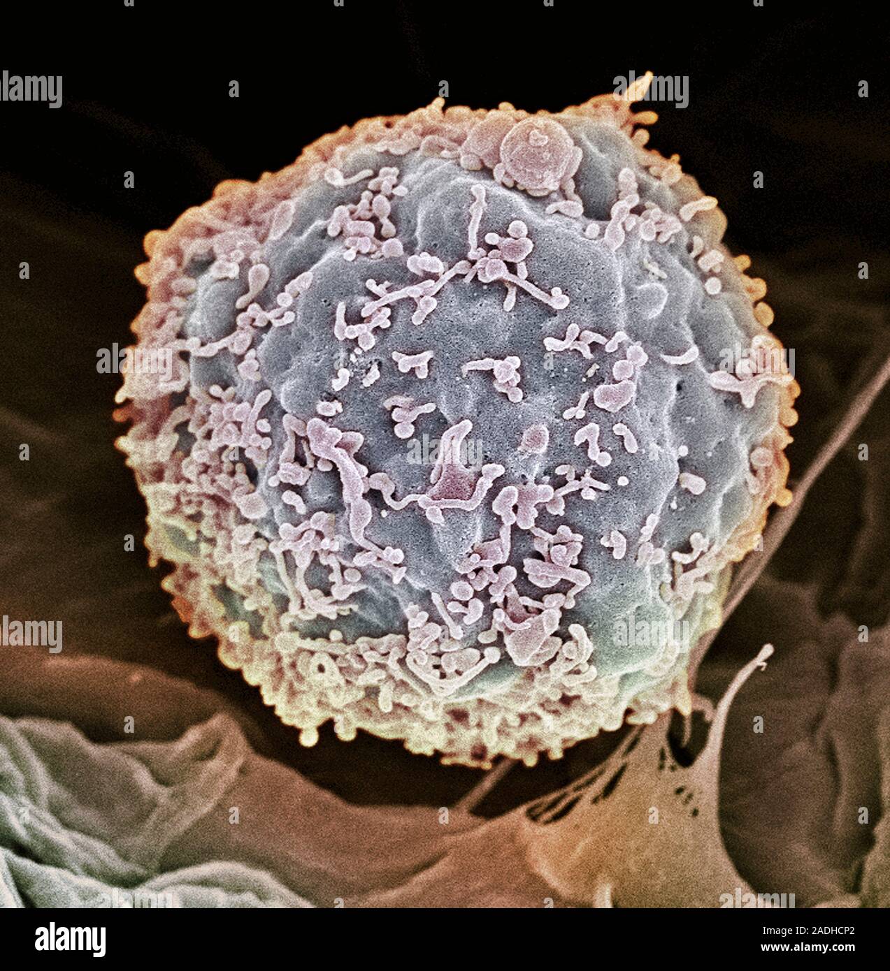 Leukaemia blood cell. Coloured scanning electron micrograph (SEM) of a ...