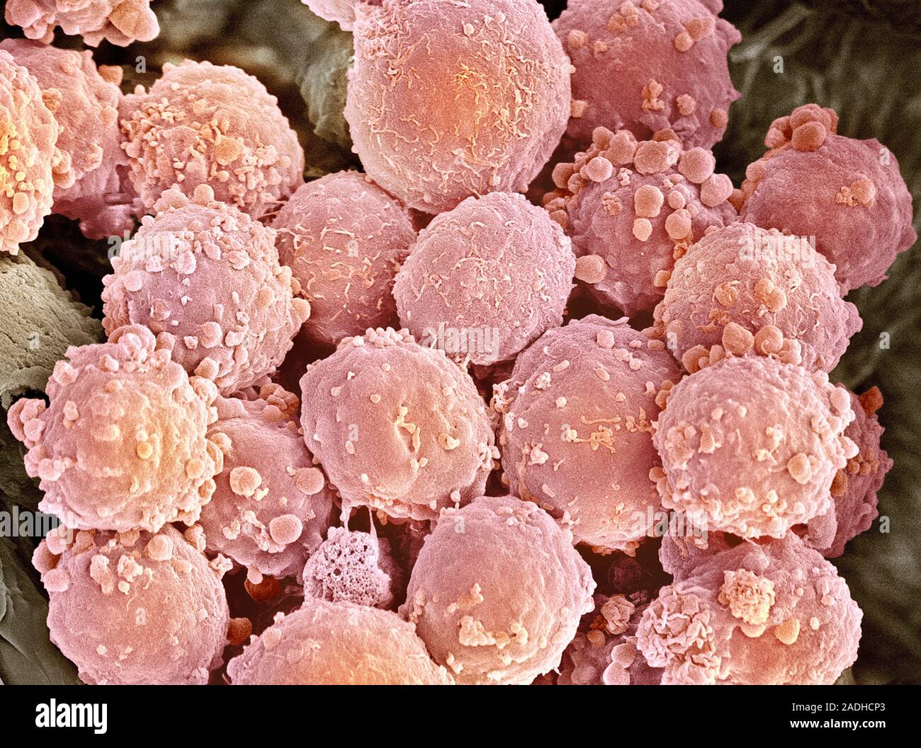 Lymphoma lymph cells. Coloured scanning electron micrograph (SEM) of ...
