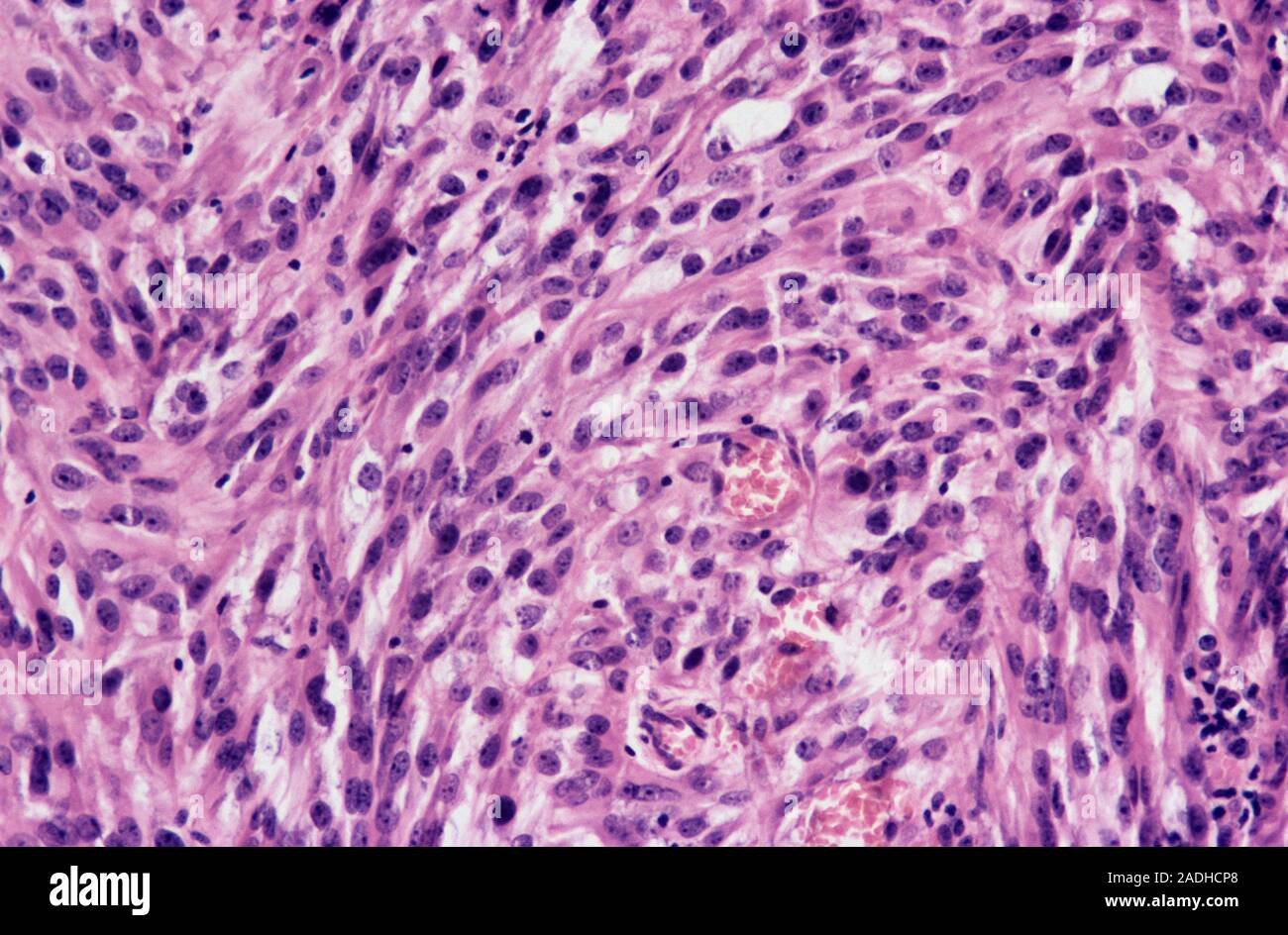 Skin cancer. Light micrograph of a section through human skin showing ...