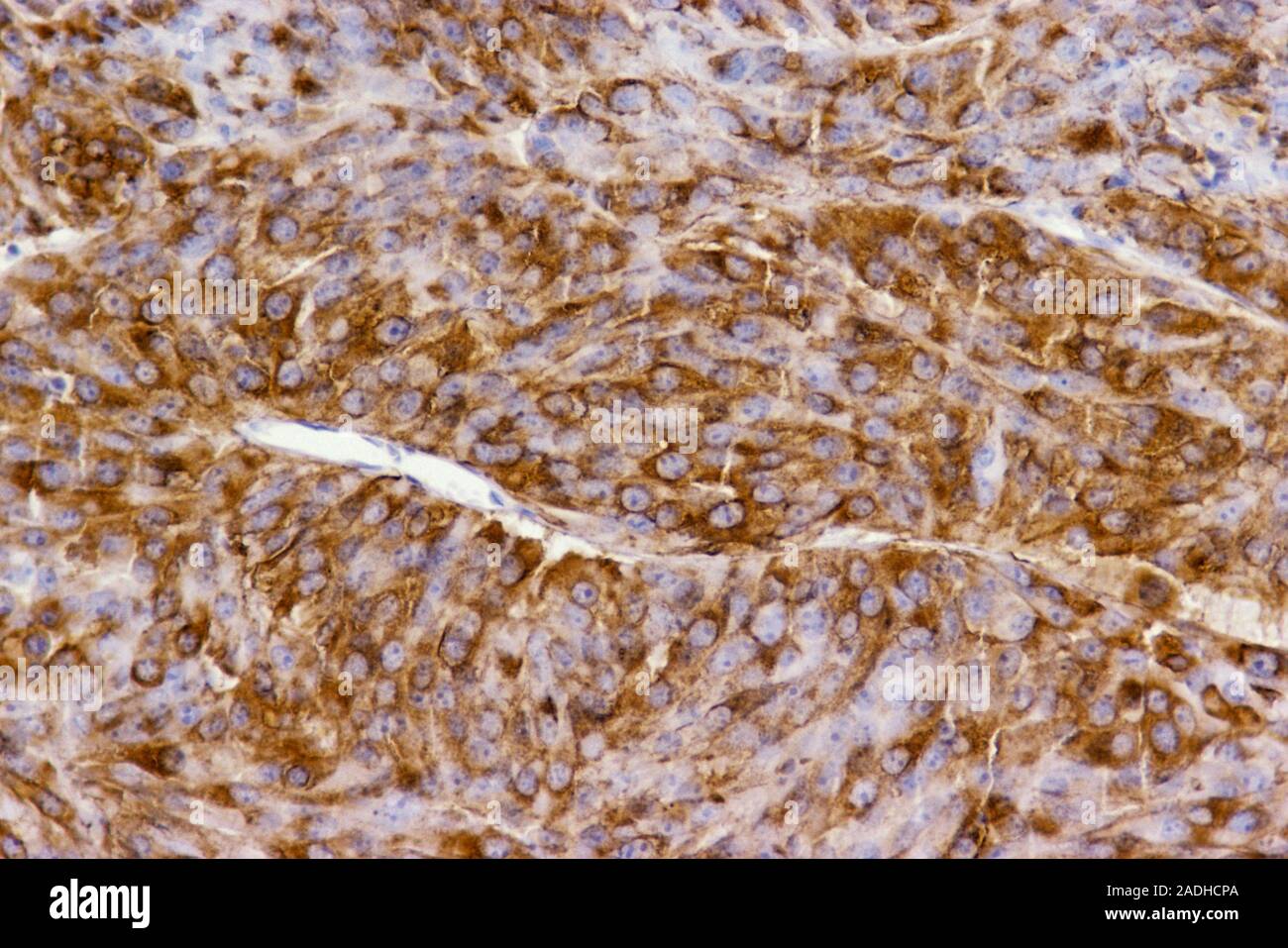 Skin cancer. Light micrograph of a section through human skin showing ...
