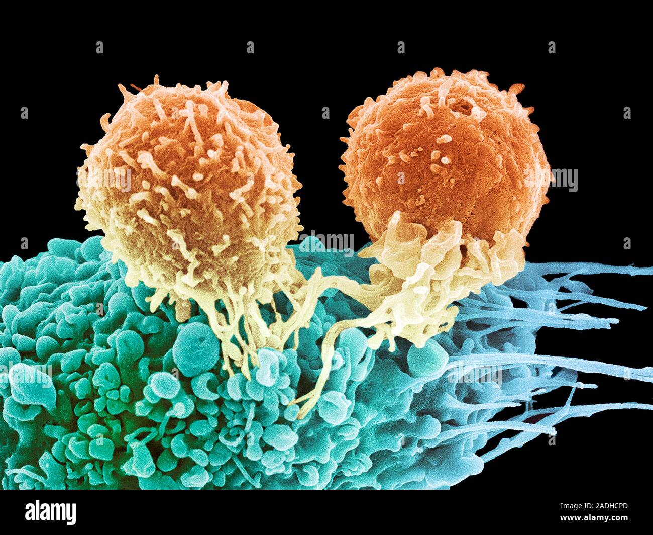 T lymphocytes and cancer cell. Coloured scanning electron micrograph ...