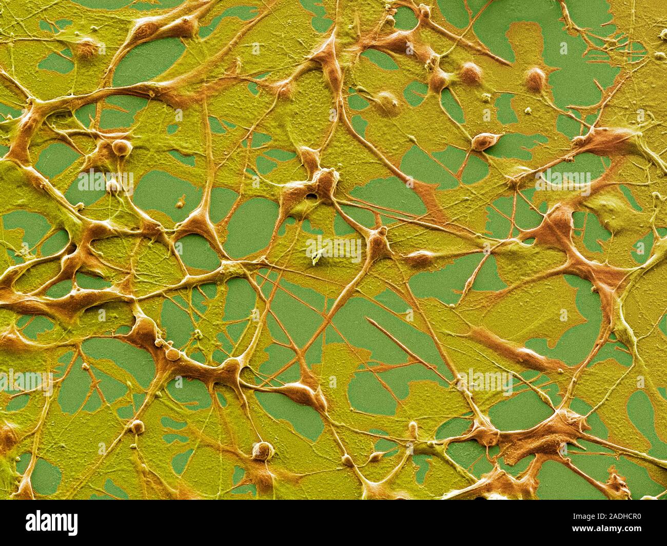 Skin cancer cells. Coloured scanning electron micrograph (SEM) of ...