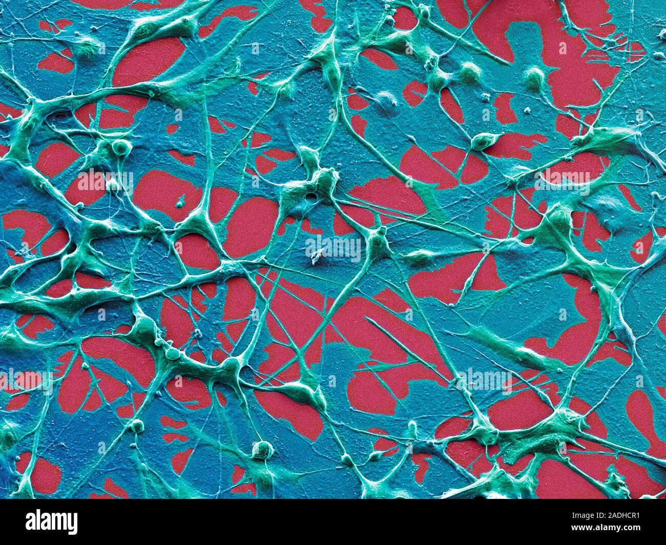 Skin cancer cells. Coloured scanning electron micrograph (SEM) of ...