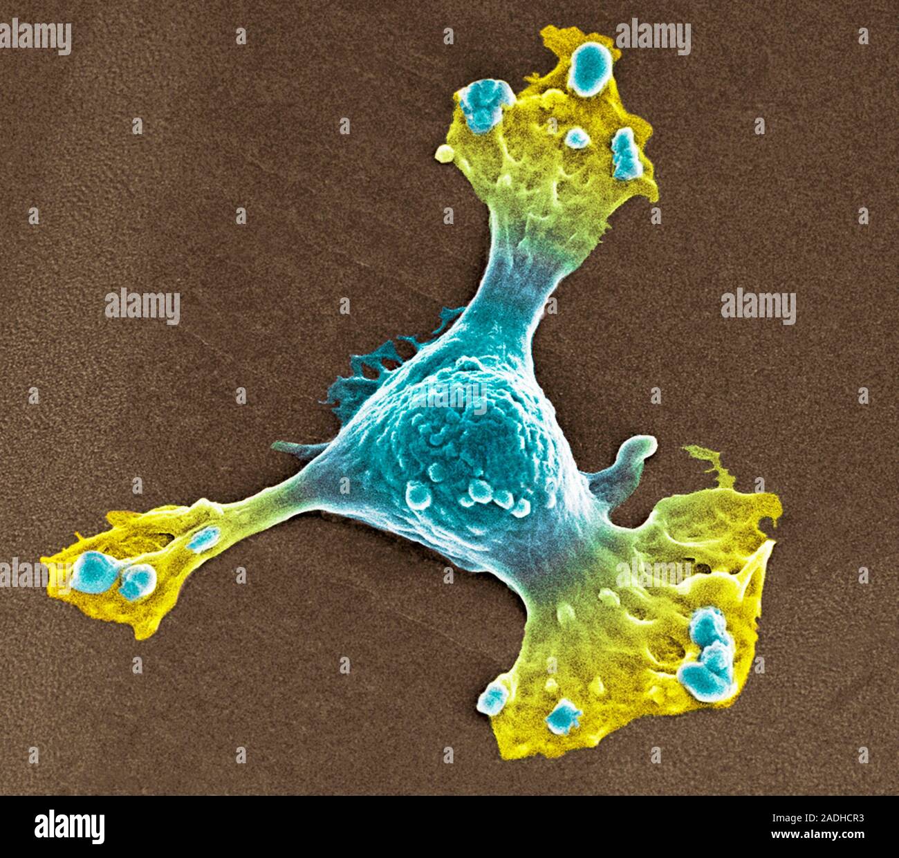 Skin cancer cell. Coloured scanning electron micrograph (SEM) of a ...