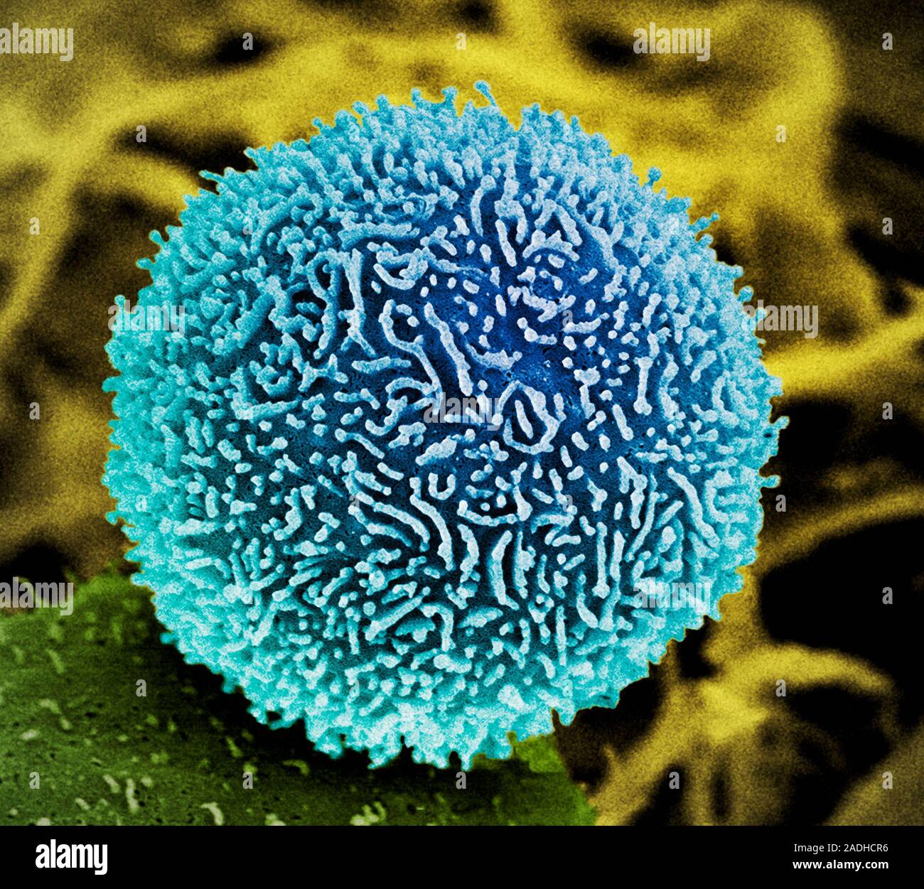 Pancreatic cancer cell. Coloured scanning electron micrograph (SEM) of ... Pancreatic cancer cell. Coloured scanning electron micrograph (SEM) of ...