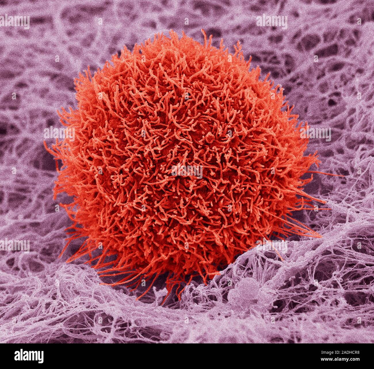 Skin cancer cell. Coloured scanning electron micrograph (SEM) of a ...