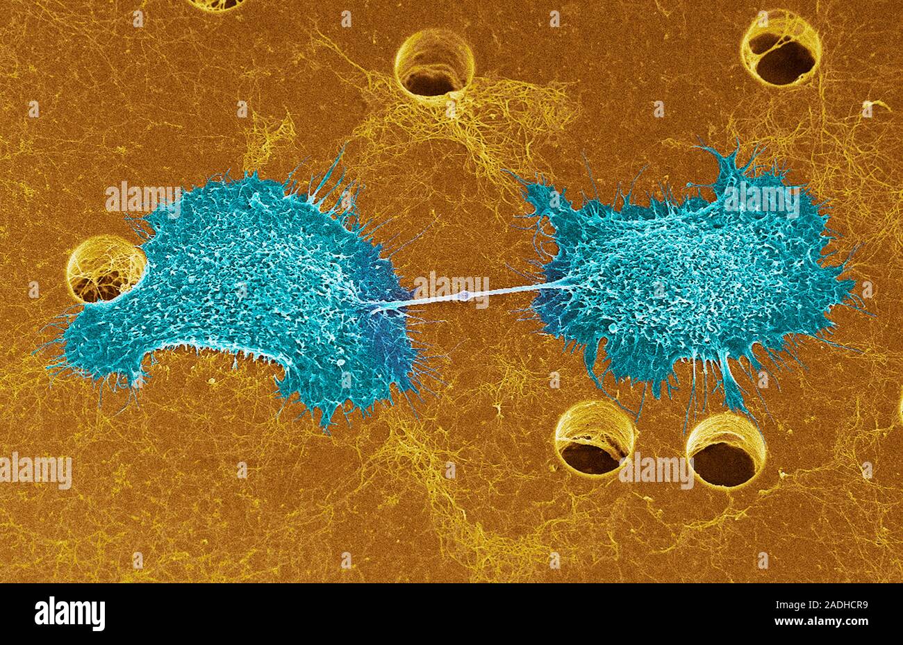 Skin cancer cell dividing. Coloured scanning electron micrograph (SEM ...
