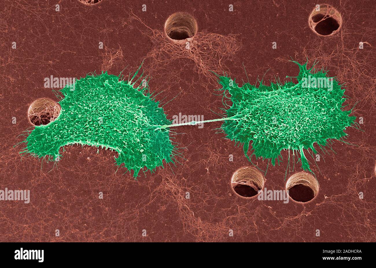 Skin cancer cell dividing. Coloured scanning electron micrograph (SEM ...