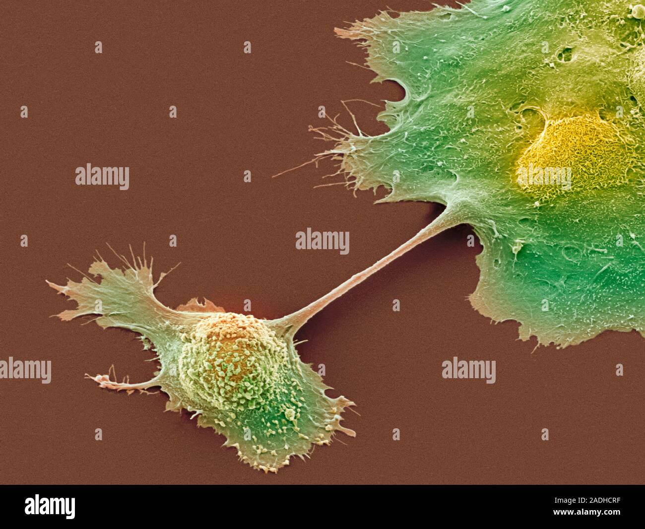 Pancreatic cancer cells. Coloured scanning electron micrograph (SEM) of ...