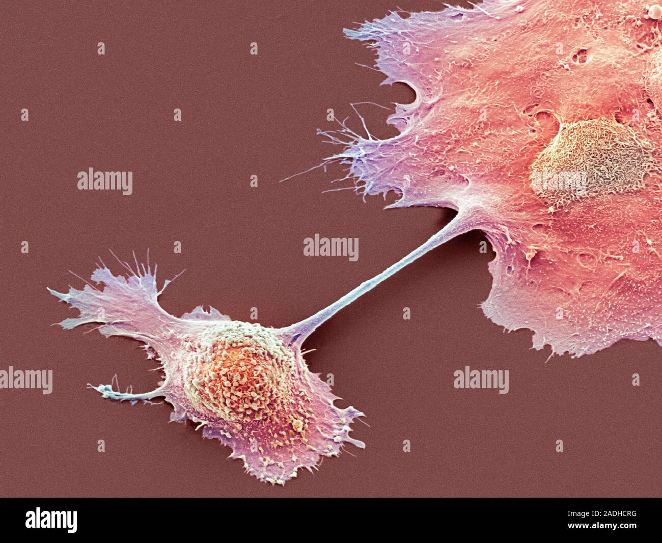 Pancreatic cancer cells. Coloured scanning electron micrograph (SEM) of ... Pancreatic cancer cells. Coloured scanning electron micrograph (SEM) of ...