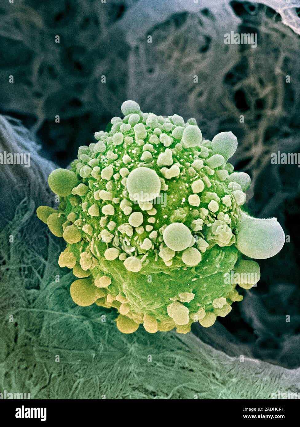 Pancreatic cancer cell. Coloured scanning electron micrograph (SEM) of ...