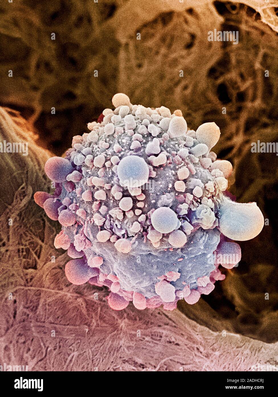 Pancreatic cancer cell. Coloured scanning electron micrograph (SEM) of ... Pancreatic cancer cell. Coloured scanning electron micrograph (SEM) of ...