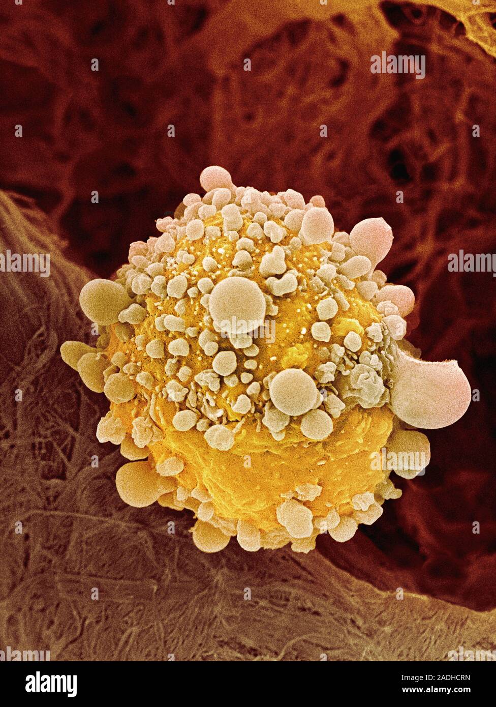 Pancreatic cancer cell. Coloured scanning electron micrograph (SEM) of ...